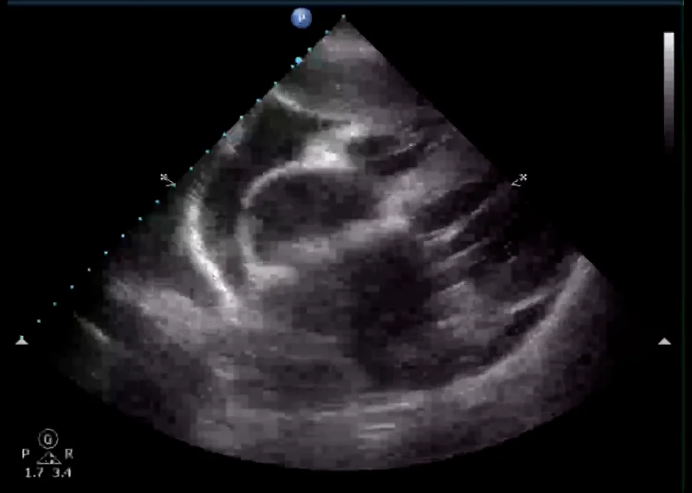 Video 49.2 D_ FAST Subxiphoid View.mp4