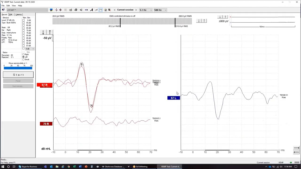 oVEMP and cVemp testing on the Interacoustics Eclipse platform on Vimeo