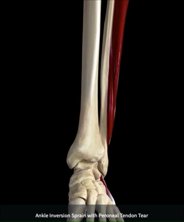 Foot Ankle Inversion Sprain with Peroneal Tendon Injury Diagnosis on Vimeo