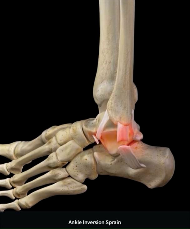 Foot Ankle Sprain Inversion Diagnosis on Vimeo