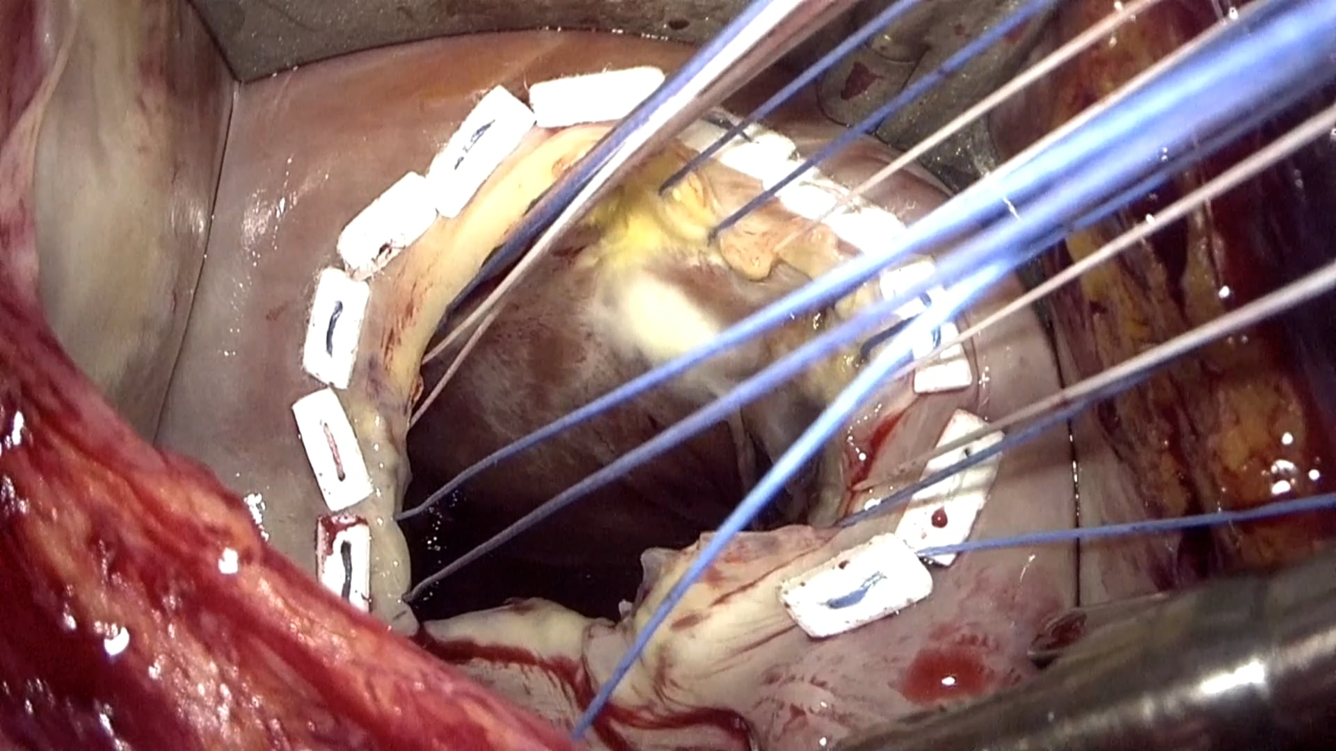 Suture map for endoscopic mitral valve replacement | MMCTS