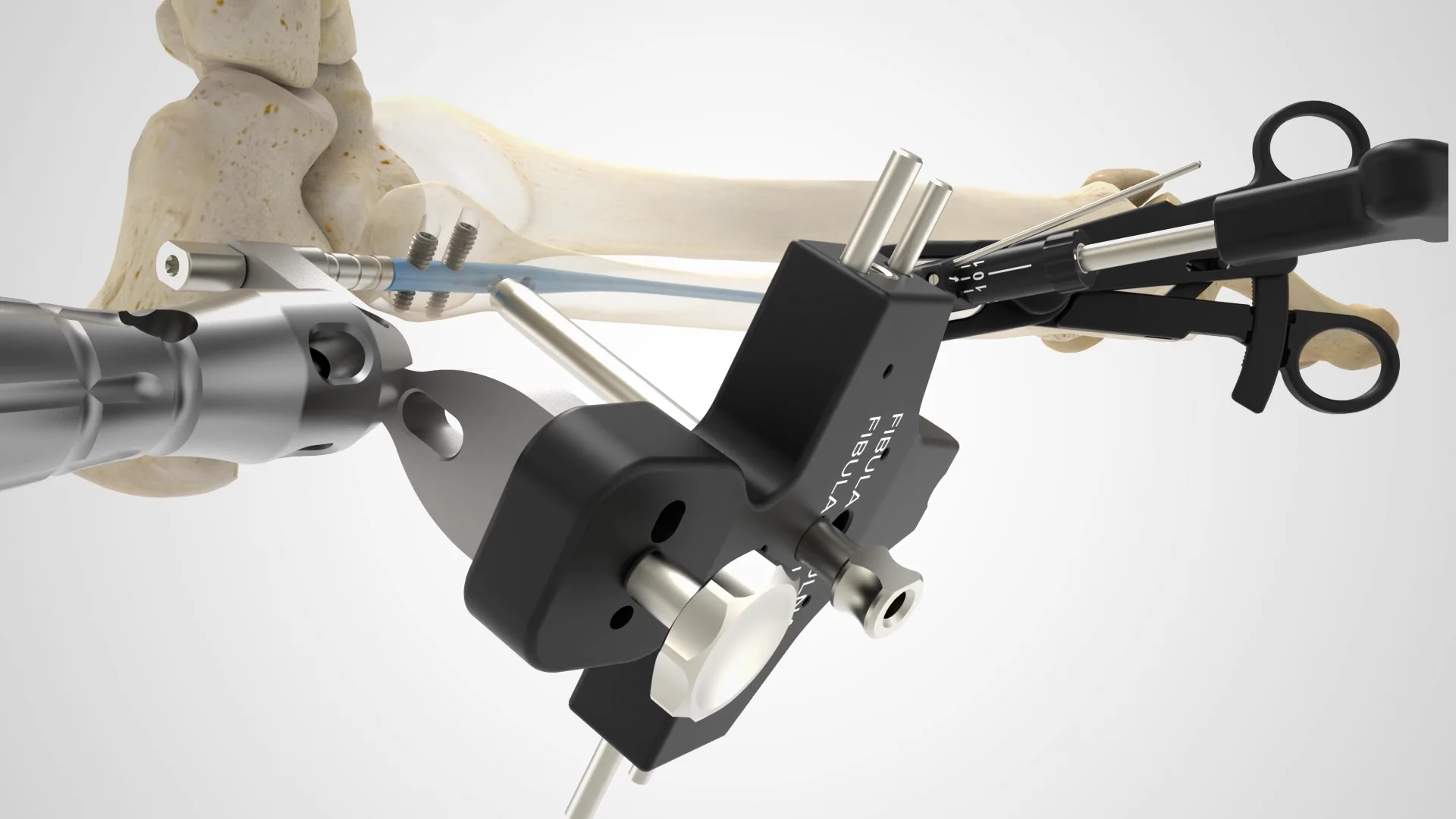 Fibula Nail 2 Surgical Technique Overview Animation