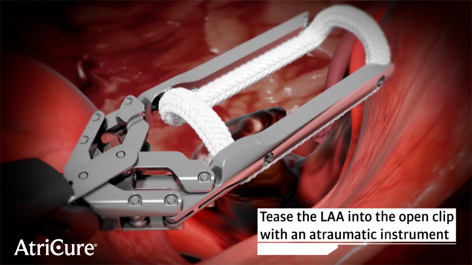AtriClip® PRO2 Device - AVR on Vimeo