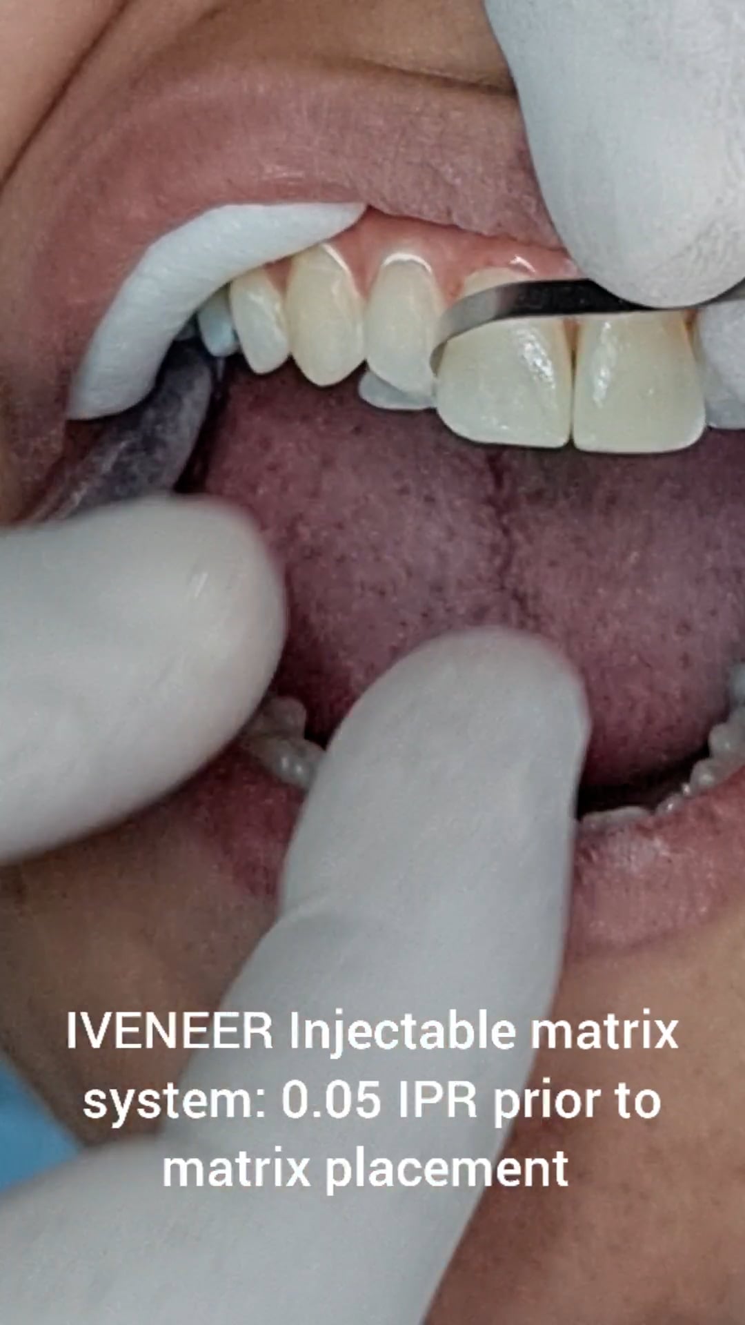 IVENEER-direct veneers injection molding technique IPR on Vimeo