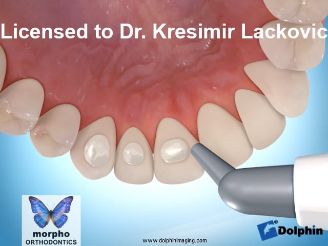 Fixed retainer (Maxillary) on Vimeo