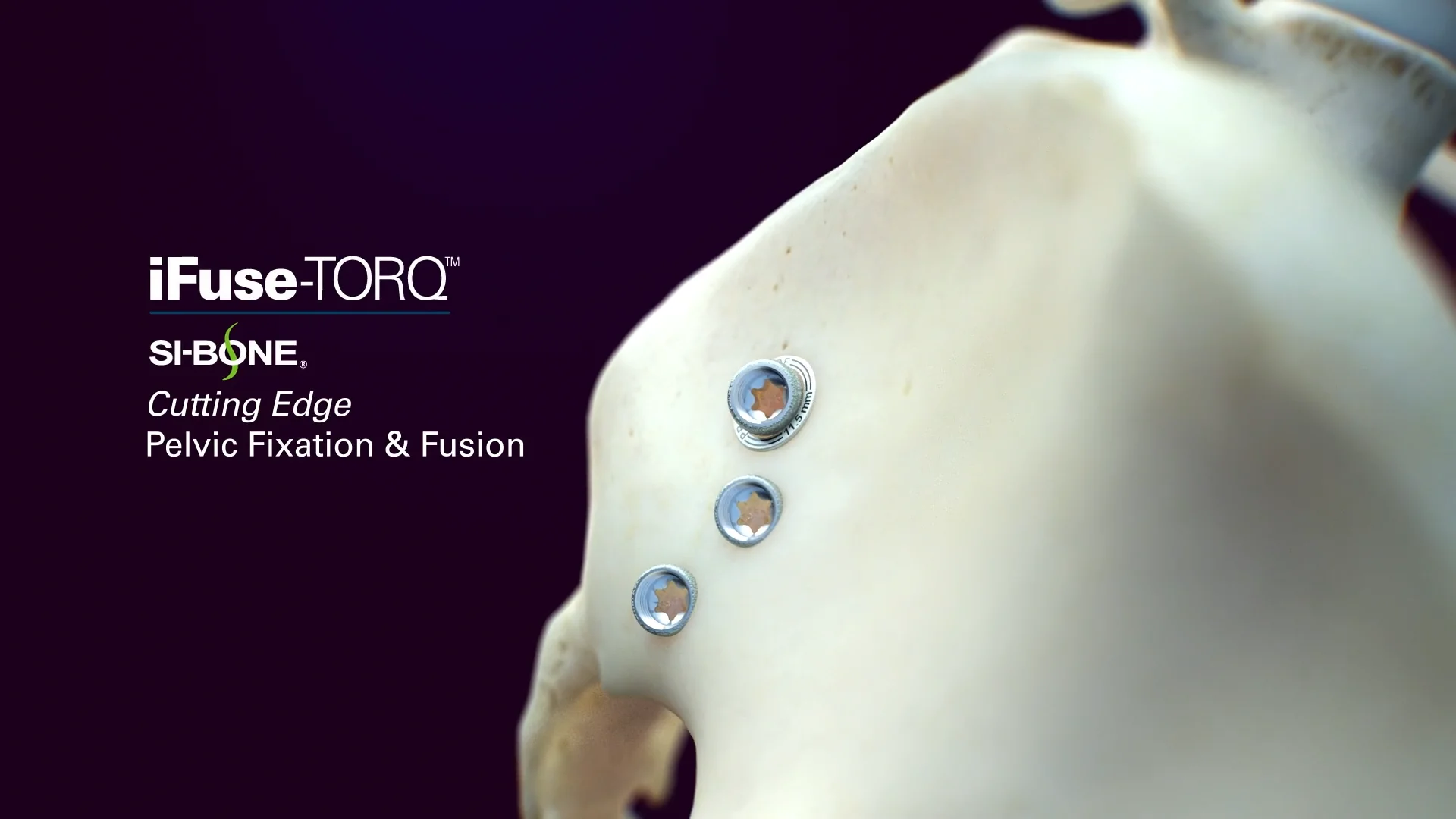 iFuse Torq Implant System