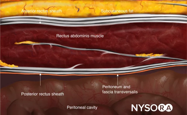 Posterior Rectus Sheath