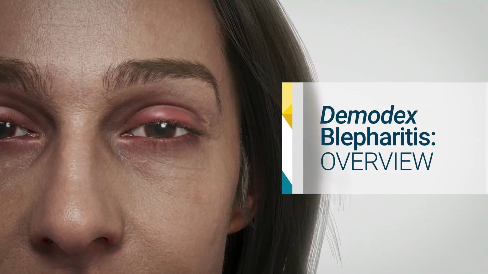 How Demodex Mites Cause Lid Margin Disease on Vimeo