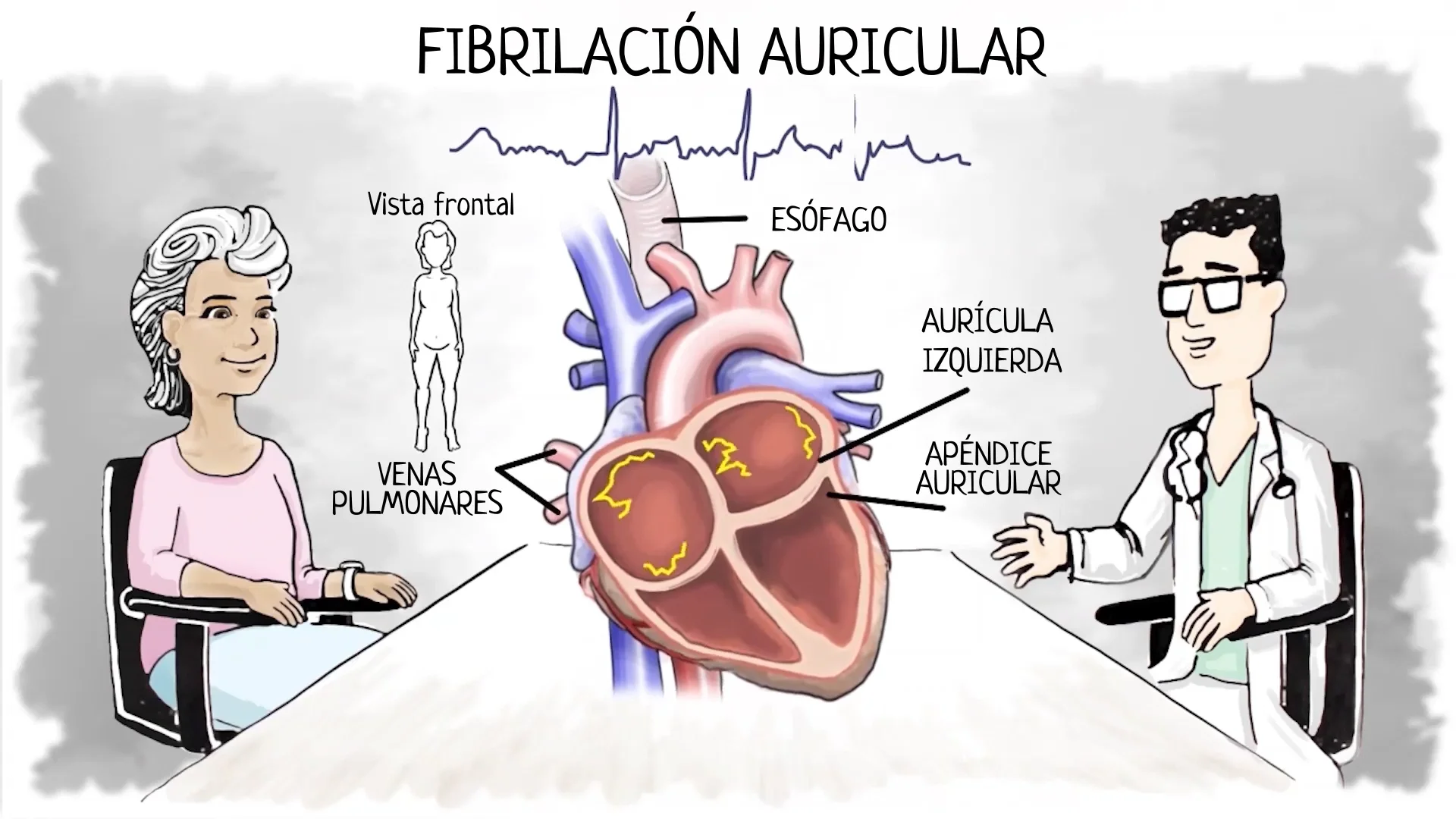 Atrial Fibrillation Animation Gif