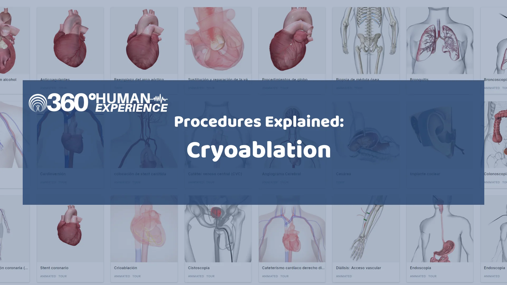 Cryoablation: Procedure Explained
