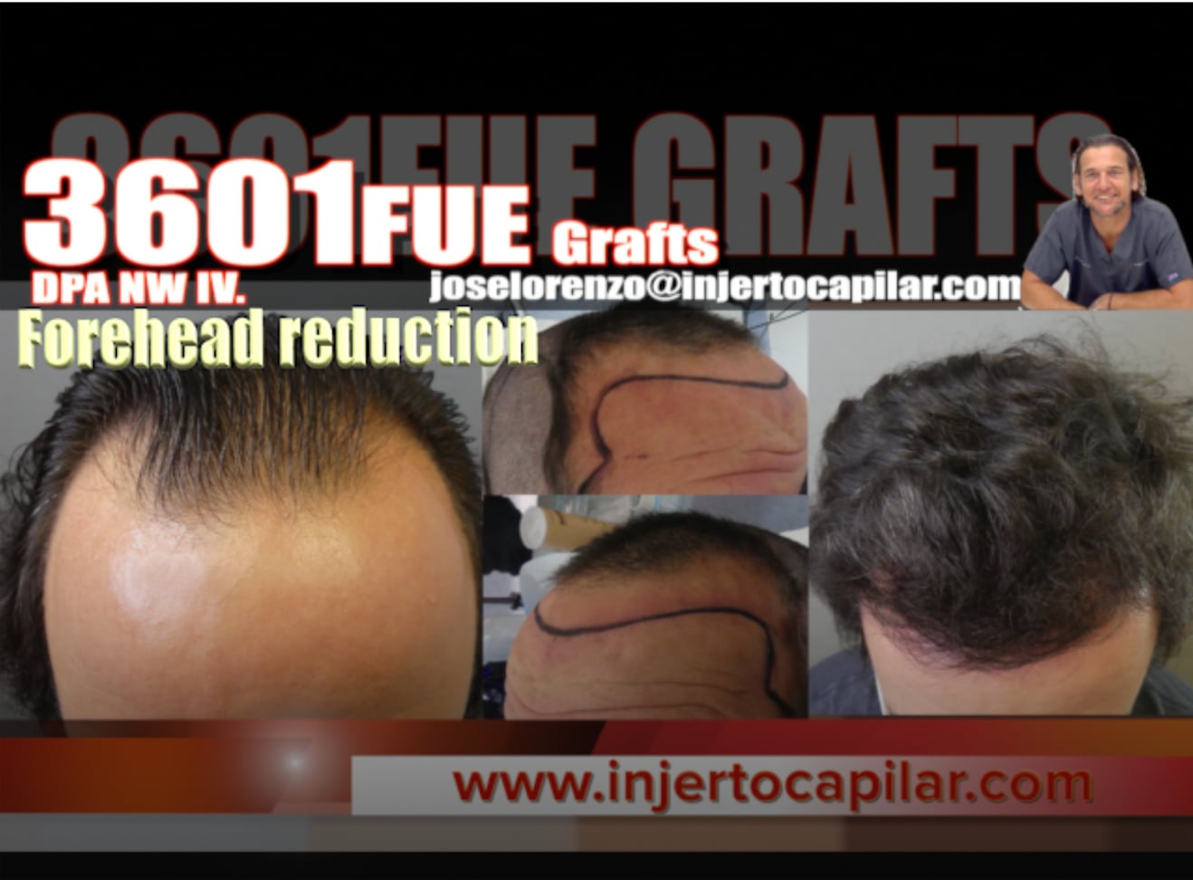 3601FUE Grafts. NW IV. Forehead reduction with temporal peaks ...