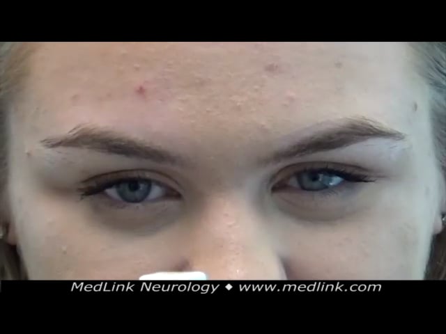Sialidosis Medlink Neurology