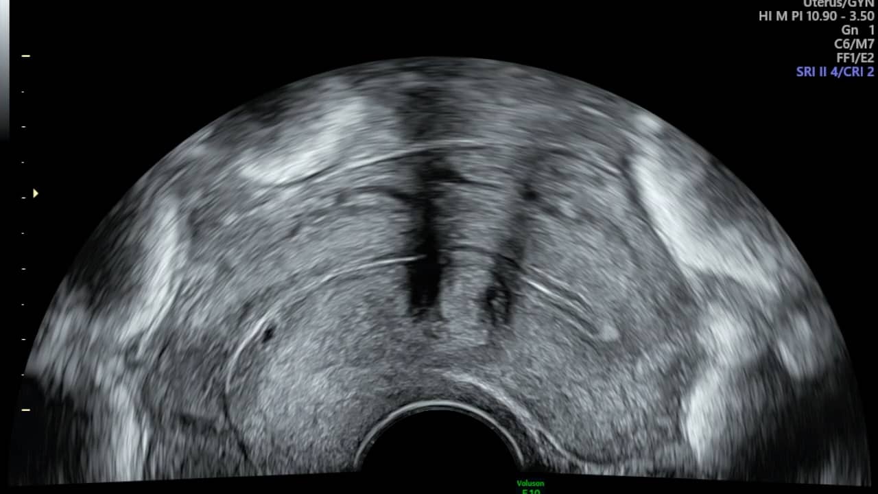 Film Fertiliscan myome type 2 réserve basse HyfoSy.mp4 on Vimeo