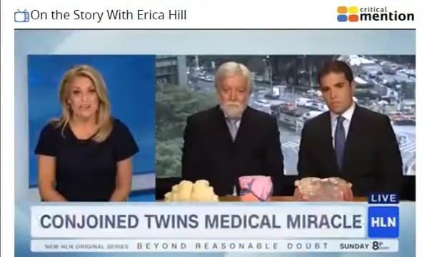 Headline News - Dr Oren Tepper - Separation Conjoined Twins on Vimeo