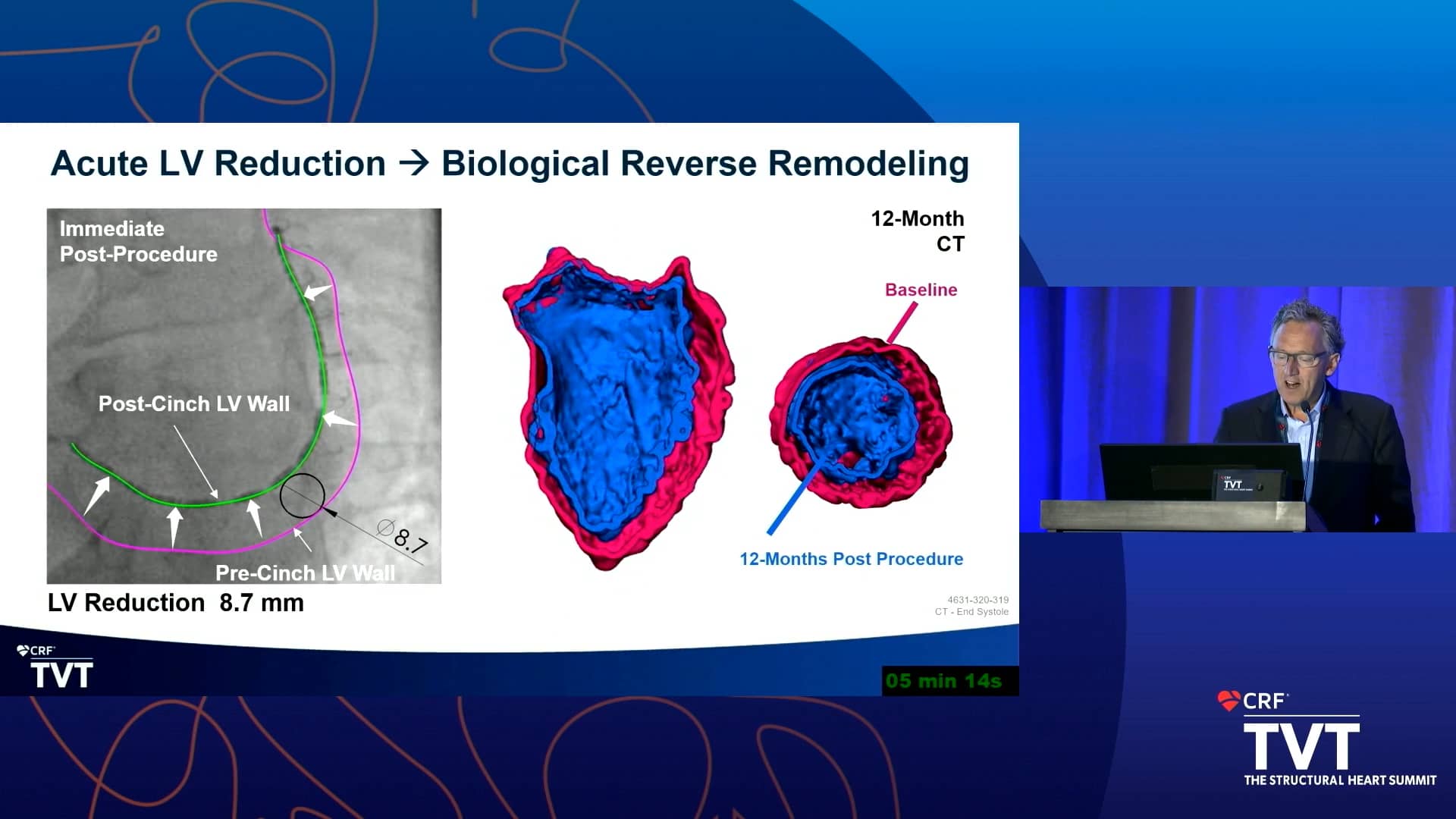 TVT 2022 - AccuCinch Ventricular Restoration for HFrEF - U.Jorde on Vimeo