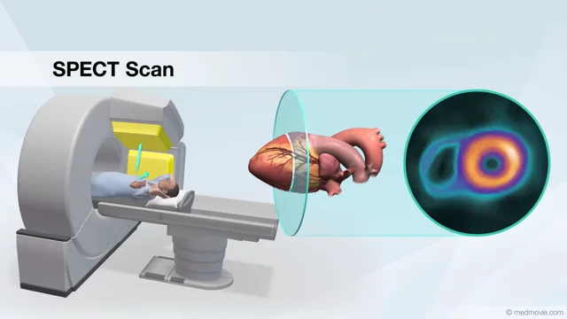 Spect Scan Heart