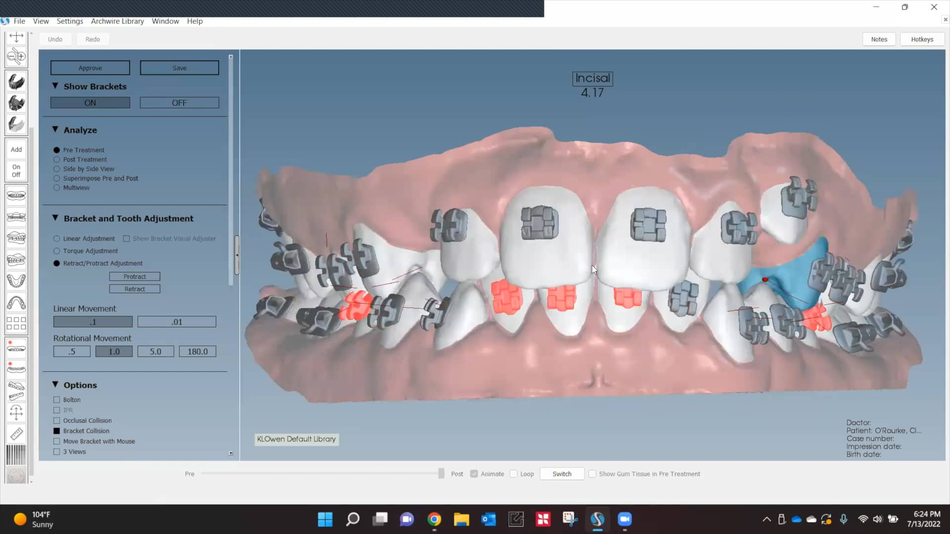 Smile Arc Protection (Advanced Treatment Planning) Webinar on Vimeo