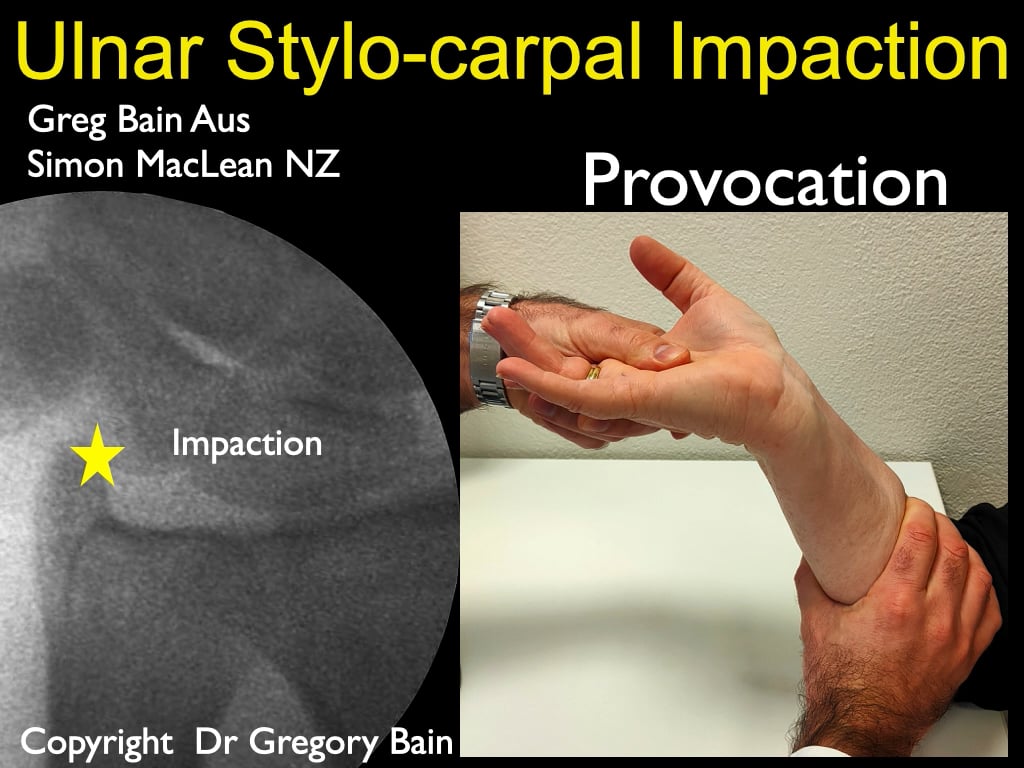 Video 13-2_ Arthroscopic Ulnar Styloidectomy on Vimeo