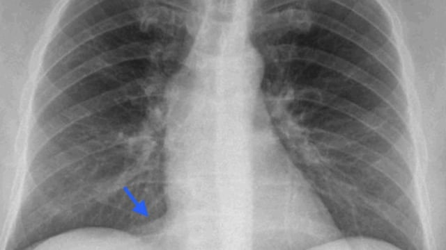 Technical aspects of a totally endoscopic, robotic-assisted pericardial ...