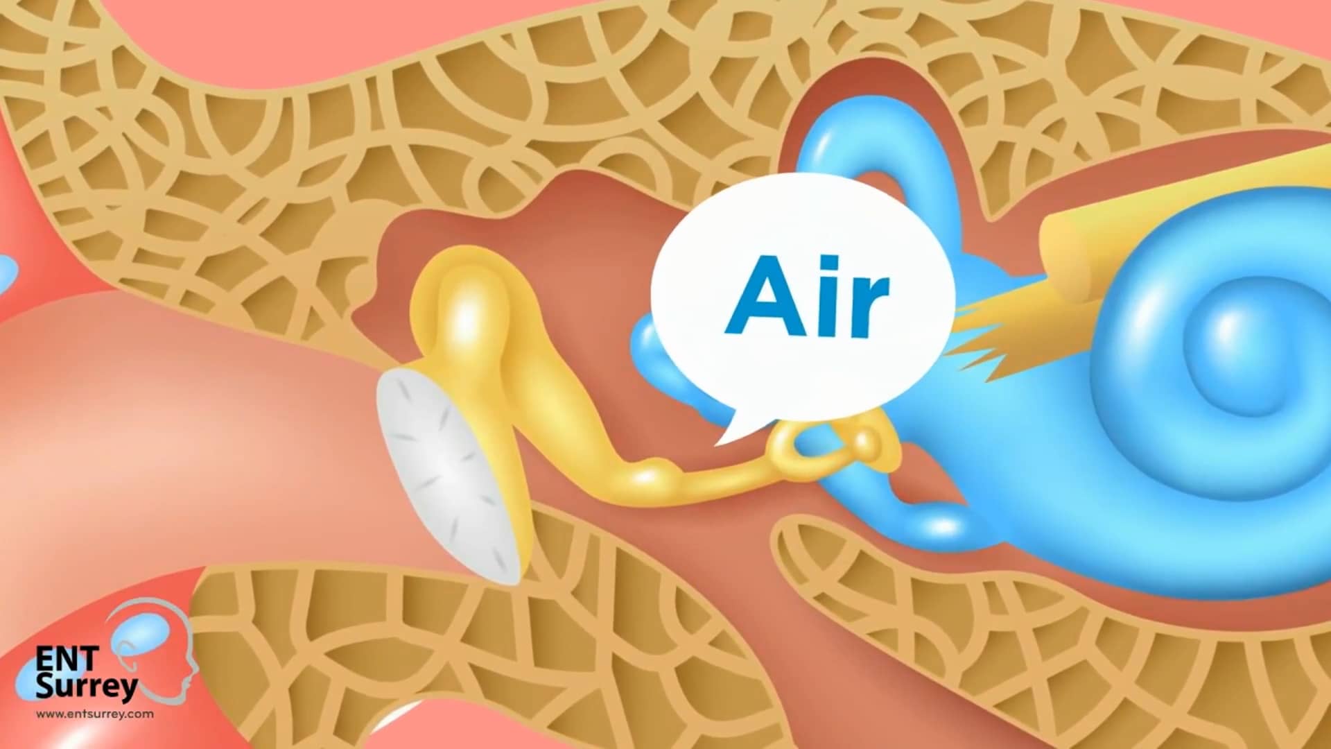 Glue Ear and how it is treated on Vimeo
