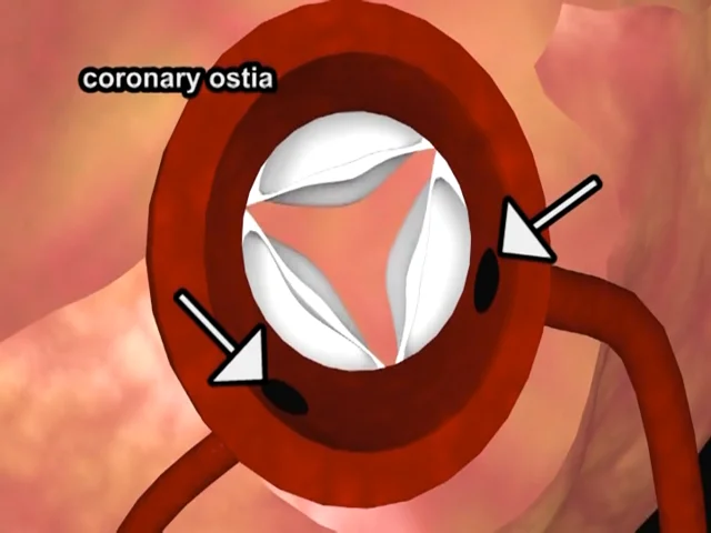 Coronary Artery Disease Animation