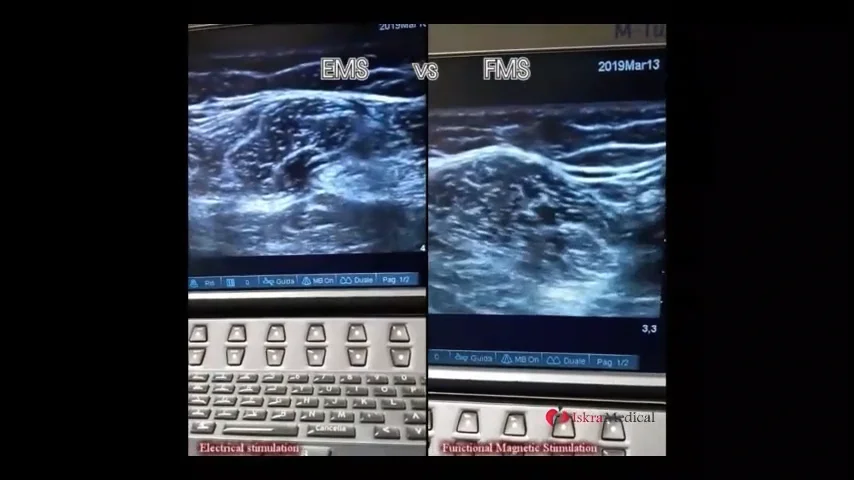 FMS vs EMS under Ultrasound Imaging.mp4 on Vimeo
