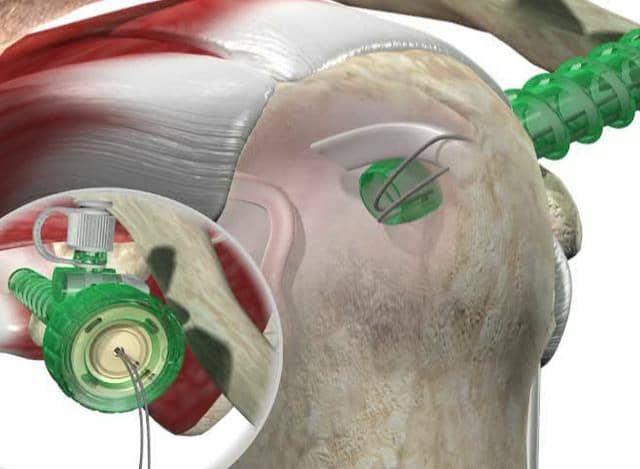 Biceps Tenodesis Surgical Technique Animation on Vimeo