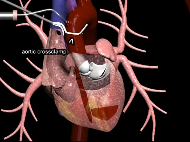Aortic Cross Clamp