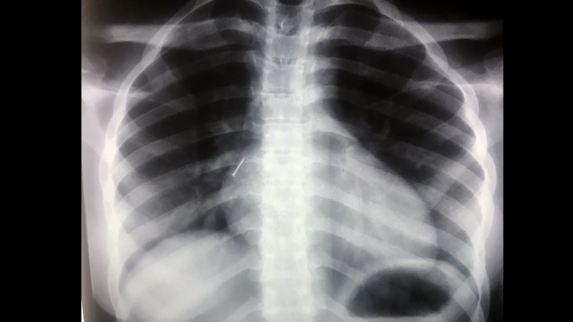Foreign body removal by a lung-sparing bronchotomy | MMCTS
