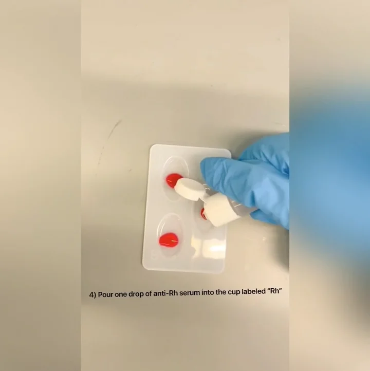 The Blood Typing Process Demonstrated and Explained in 5 Steps by ...
