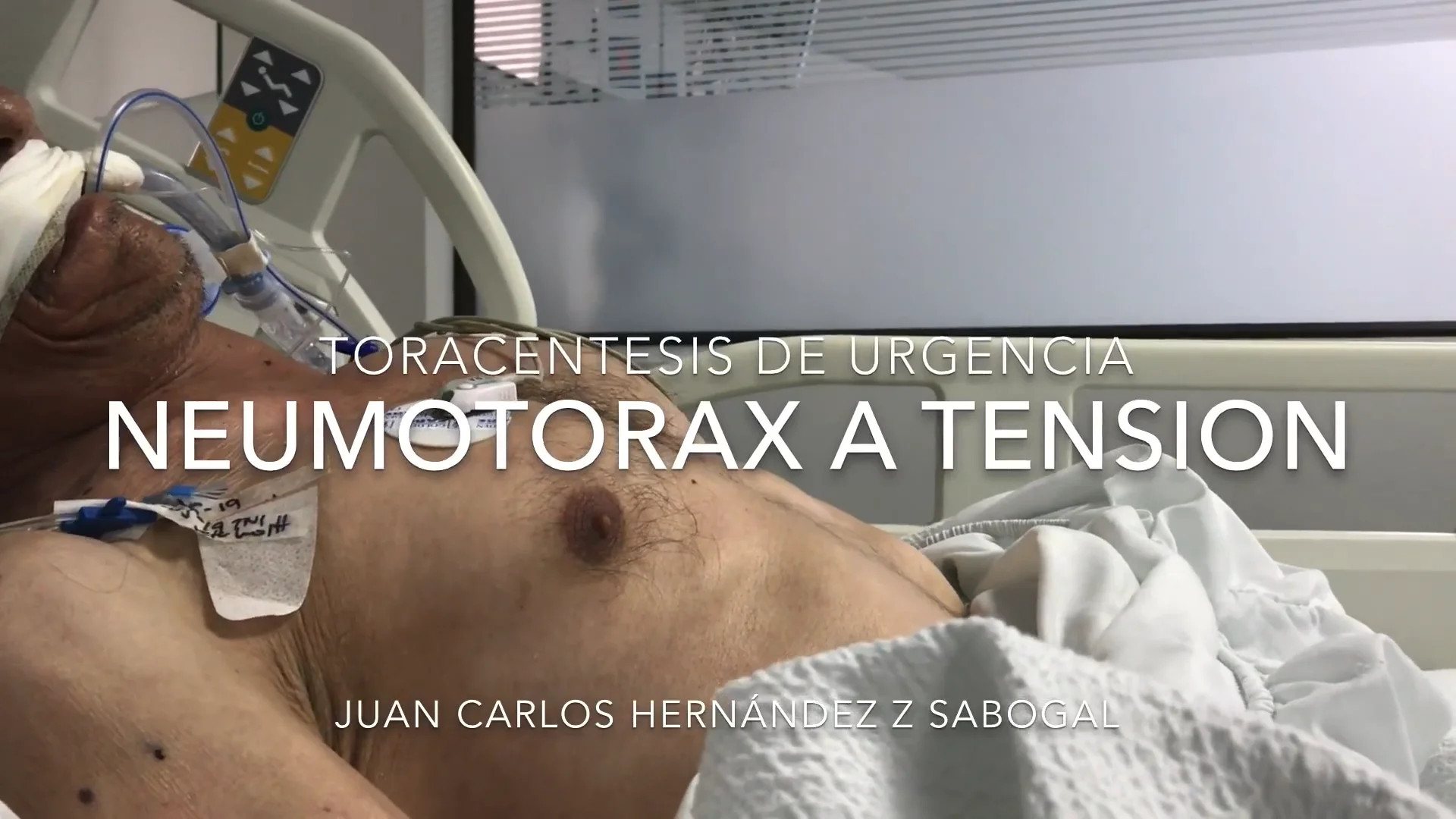 Manejo de Neumotorax a tension de Urgencia con toracentesis.