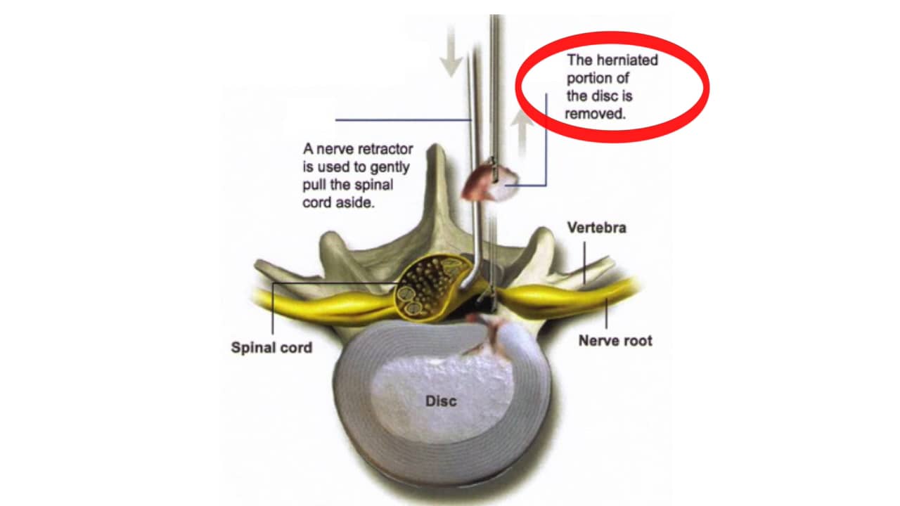 41-yo-f-status-post-l4-l5-microdiscectomy-on-vimeo