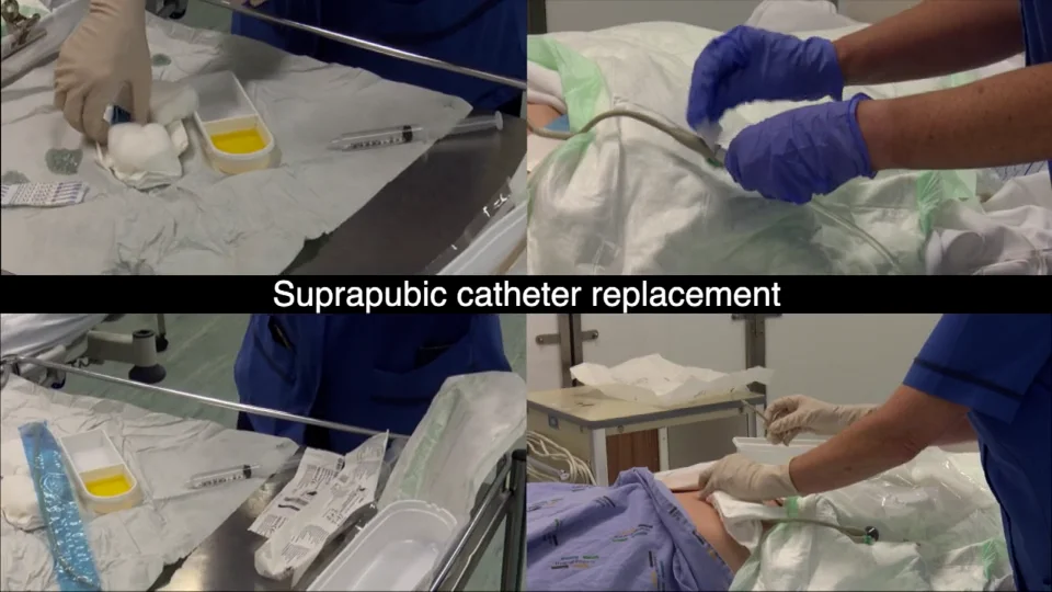 Suprapubic Catheter Replacement on Vimeo
