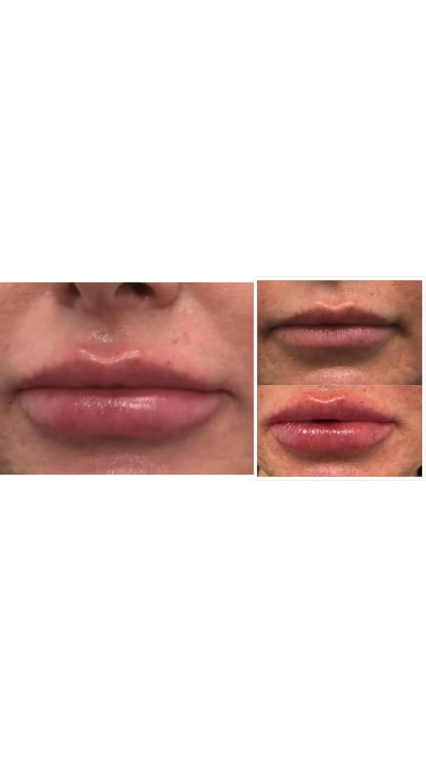Revanesse Lips+ Filler on Vimeo