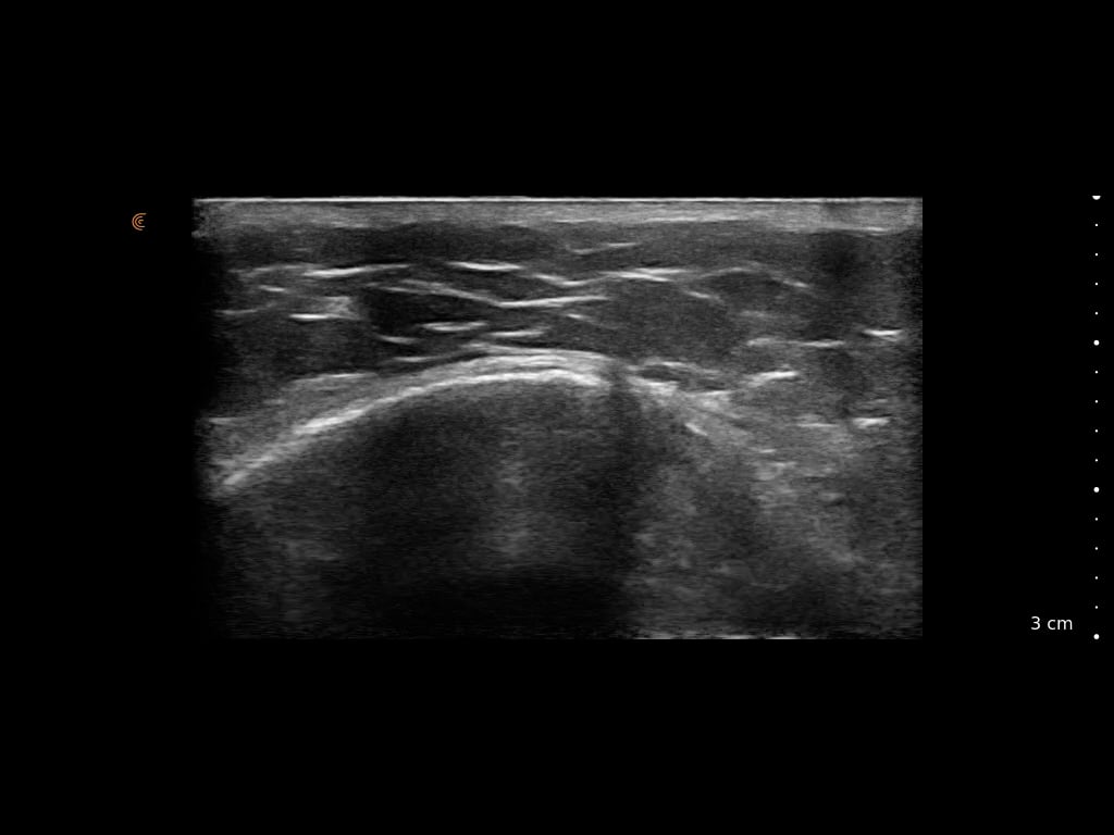 Knee Ultrasound Guided Ostenil Injection on Vimeo