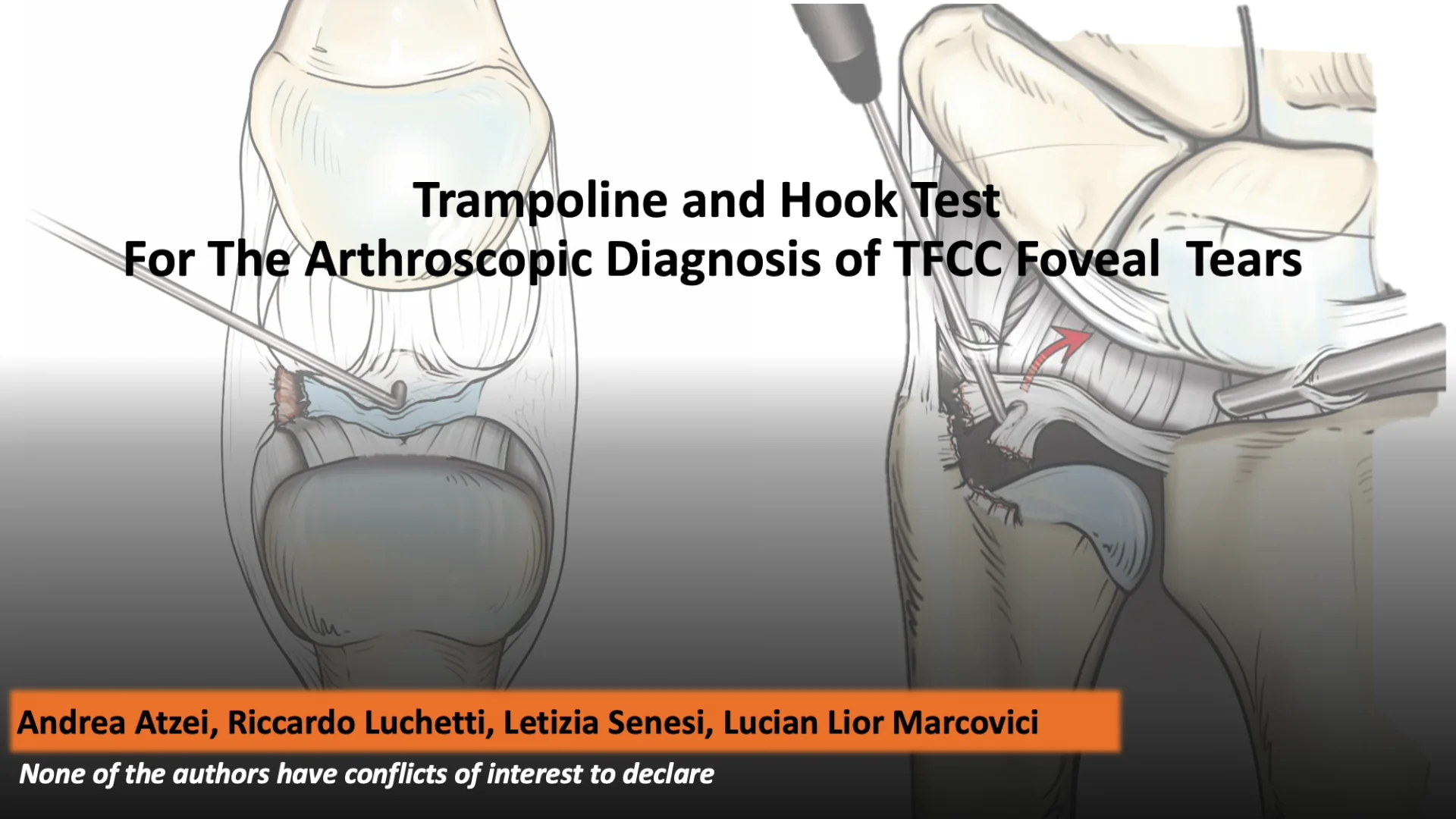 Video 11-2_ Arthroscopic TFCC Testing by Trampoline and Hook Tests on Vimeo