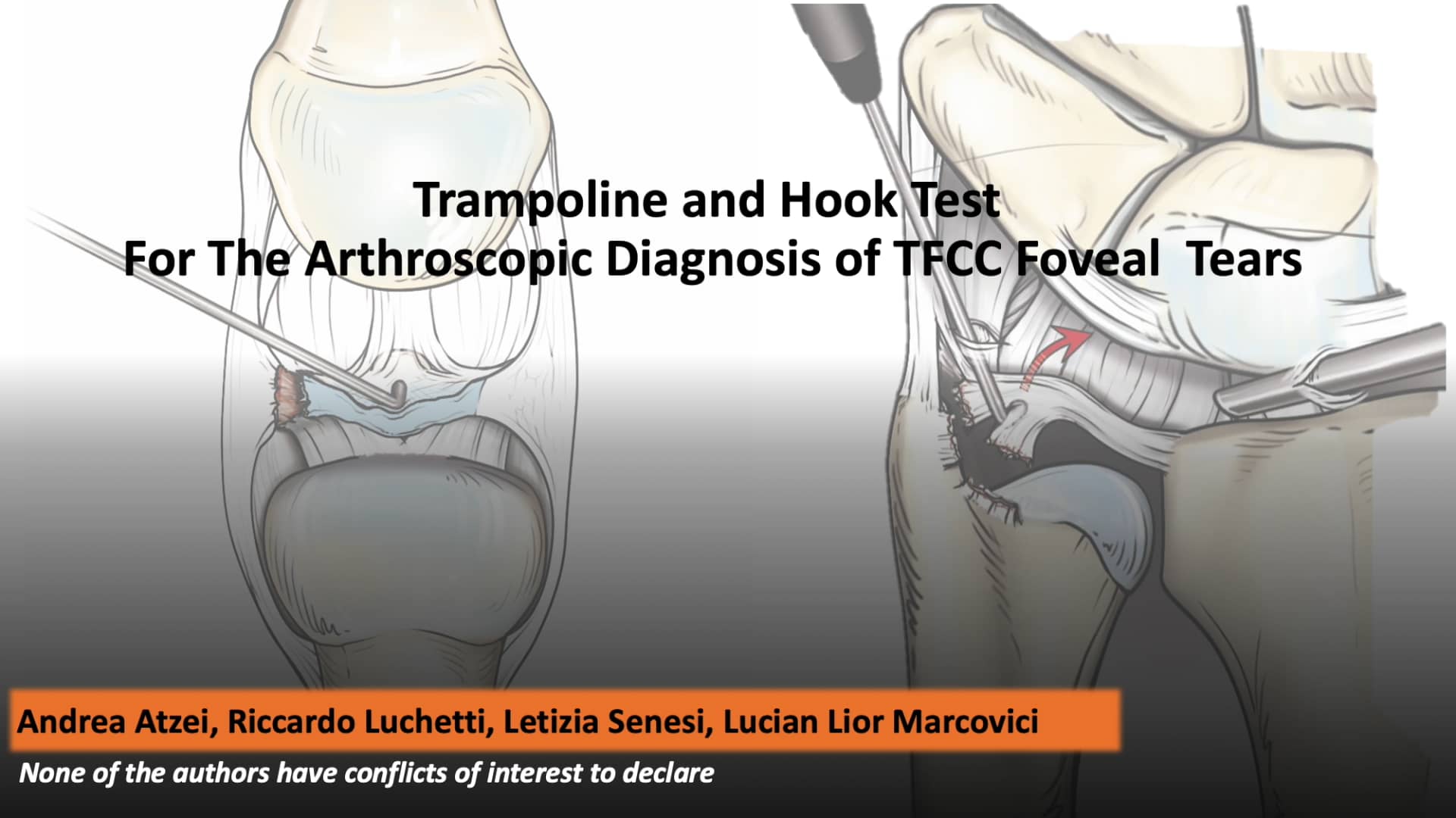 Video 11 2 Arthroscopic Tfcc Testing By Trampoline And Hook Tests On Vimeo