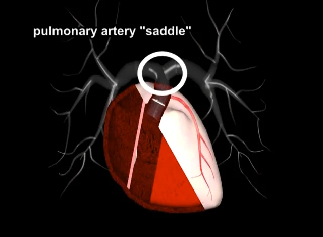 Saddle Pulmonary Embolism Diagram