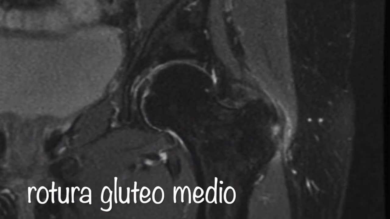 Cirugía rotura glúteo medio on Vimeo