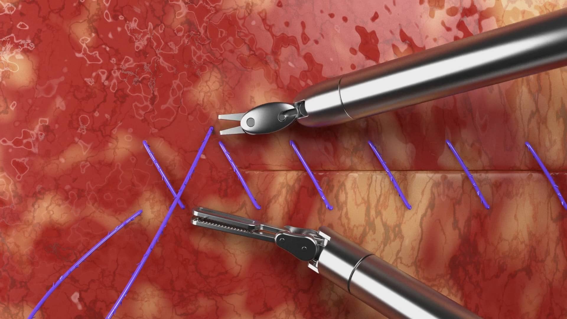 Animation of Quill Uni-directional Barbed Suture use in Robotic ...