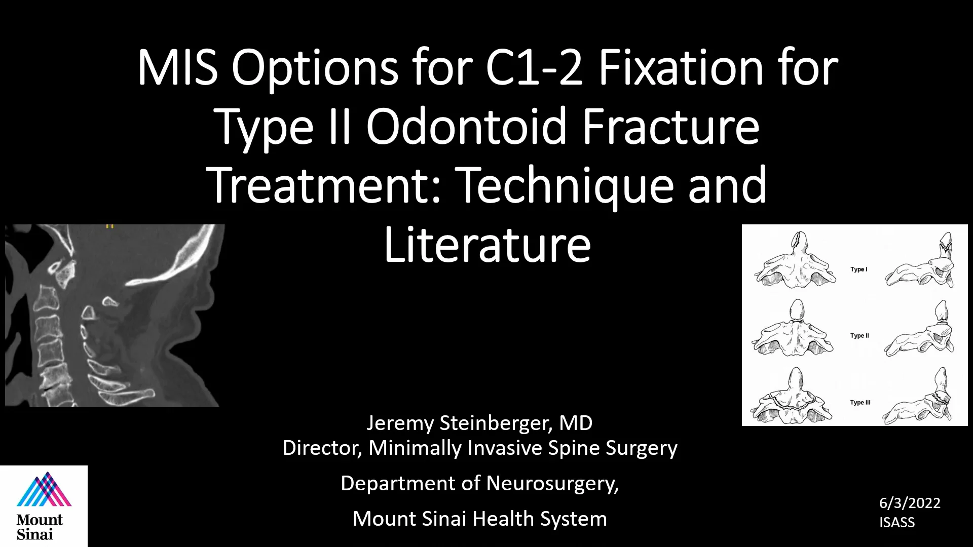 mis options for c1-2 fixation for type ii odontoid fracture treatment ...