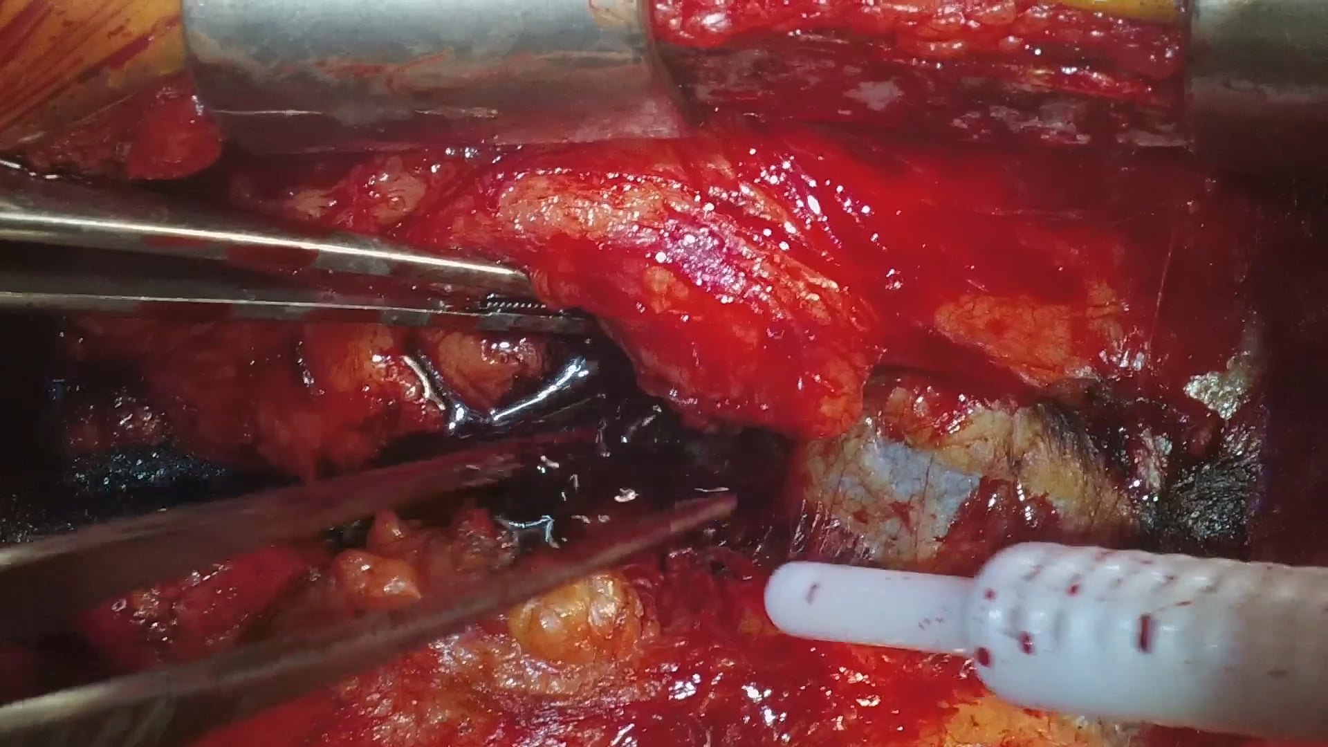 Hybrid arch frozen elephant trunk repair for acute type A aortic ...