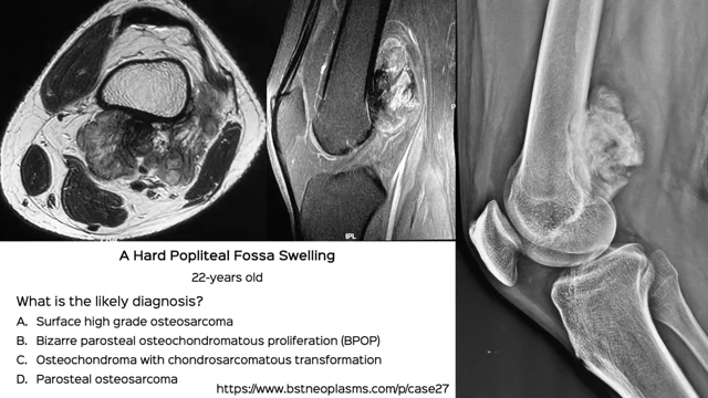Popliteal Fossa Swelling