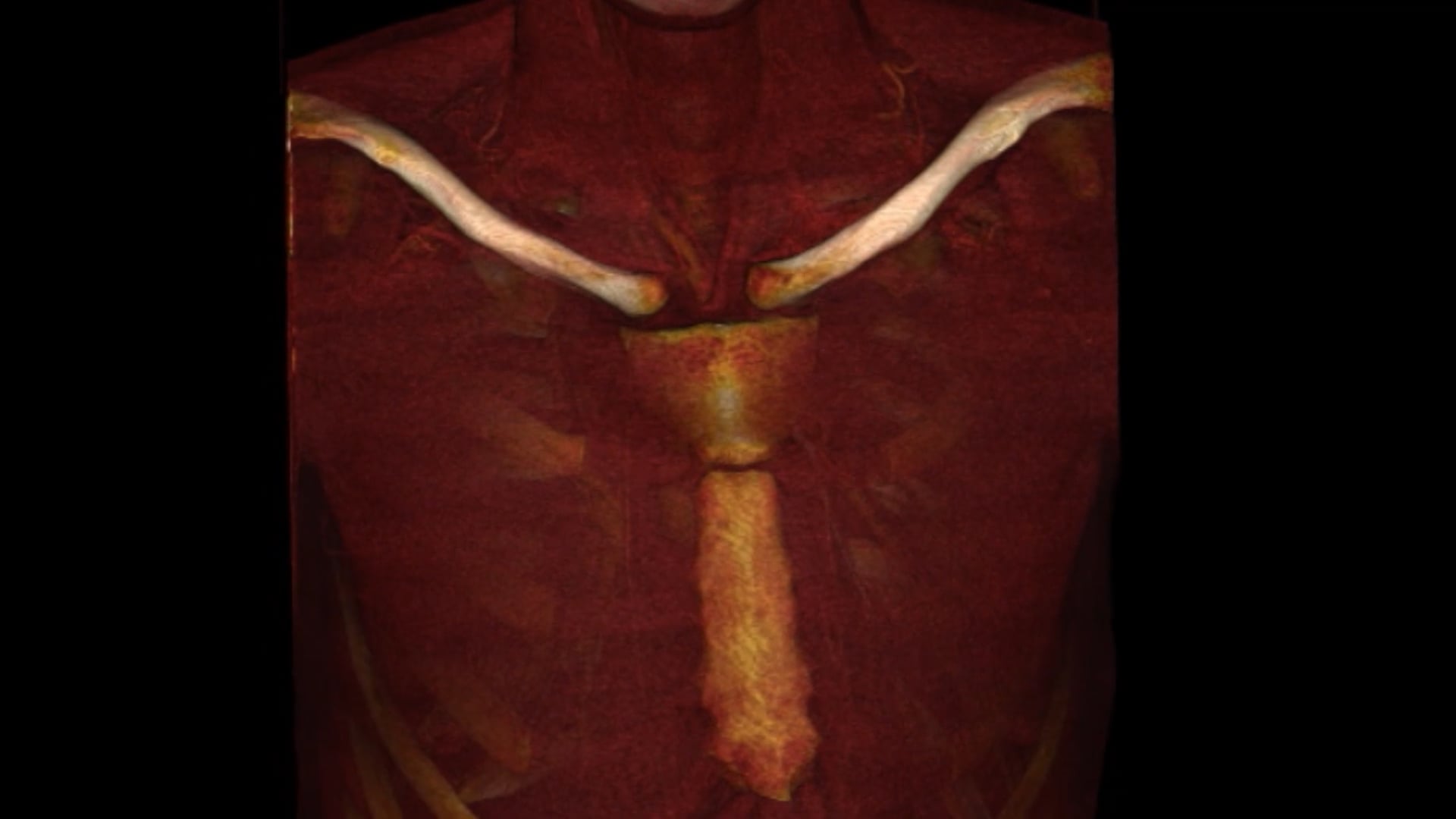 How to perform a direct axillary artery cannulation | MMCTS