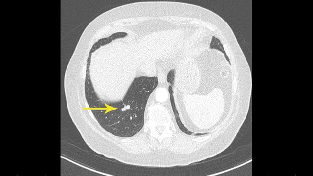 Thoracoscopic right-S10 segmentectomy: Alternative posterior approach ...