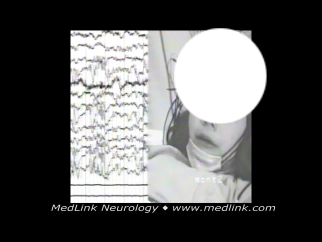 Self-limited epilepsy with autonomic seizures | MedLink Neurology