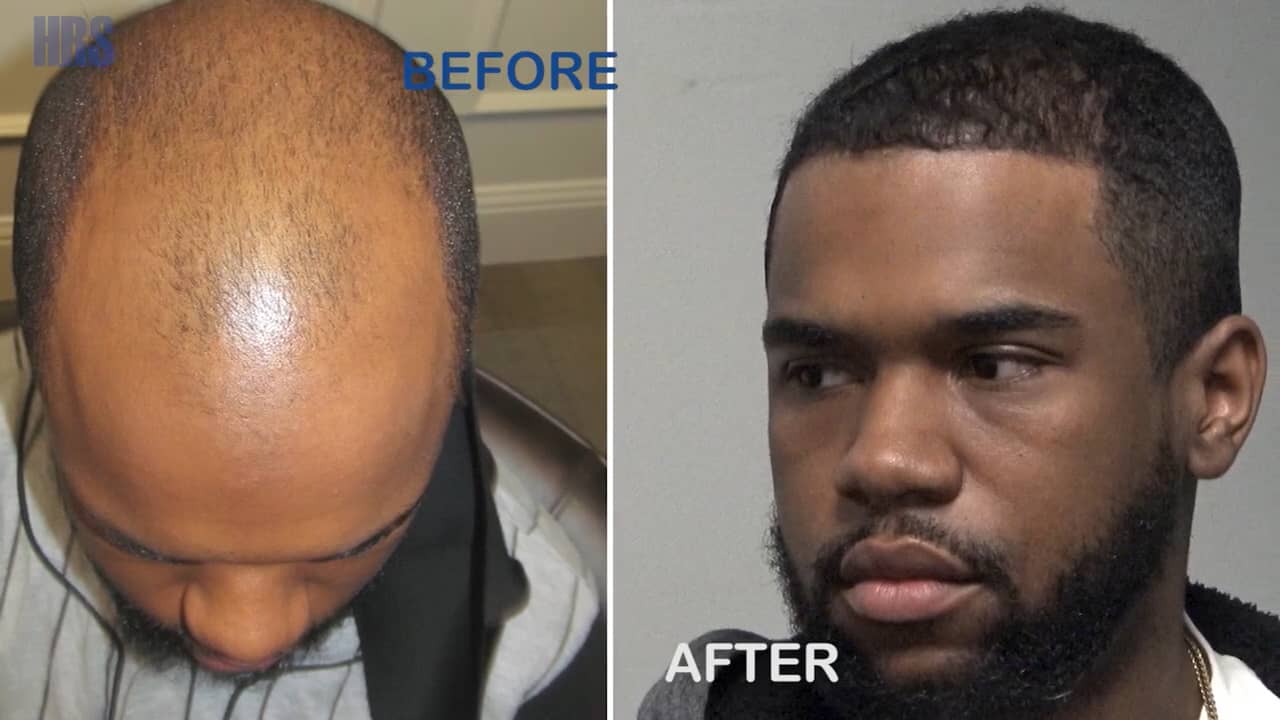 African American Hair Transplant - Results 9 Months Later on Vimeo