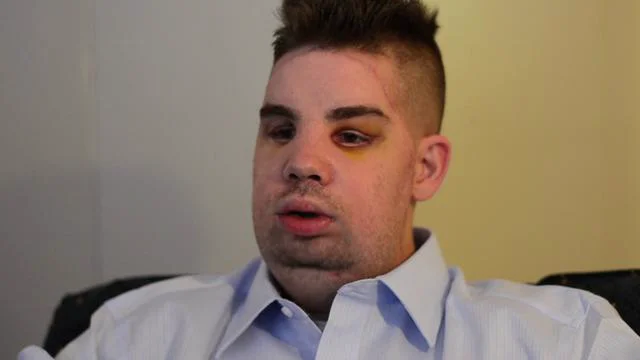 Full Face Transplant Recipient Mitch Hunter on Vimeo
