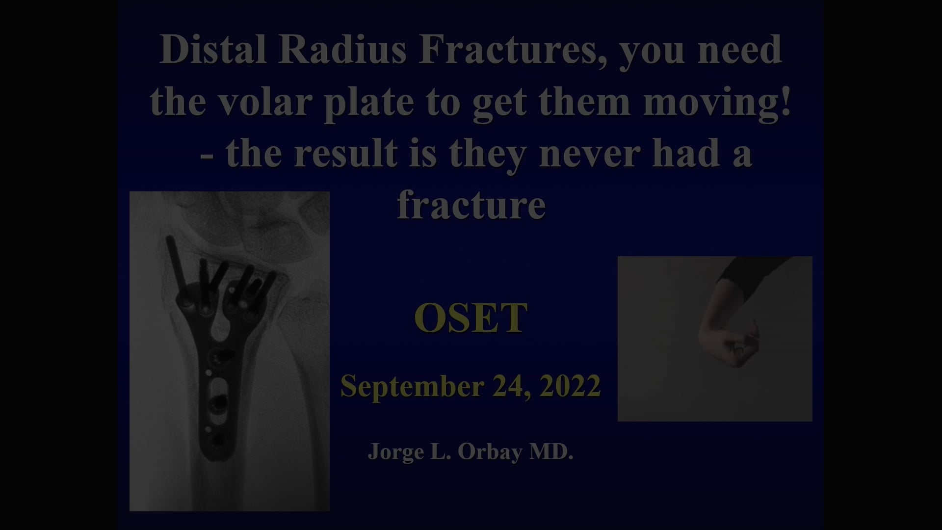 004 Distal Radius Fractures- You-Need The Volar Plate To Get Them ...