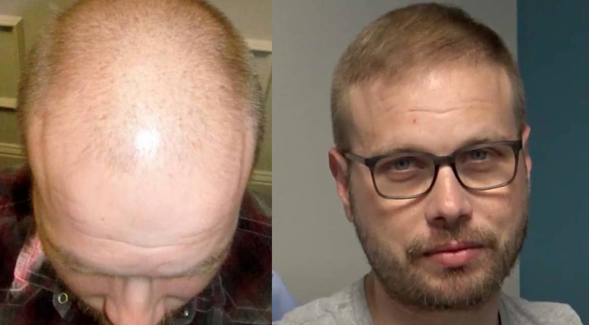 Full Head Restoration - 7 Months Later With Stewart on Vimeo